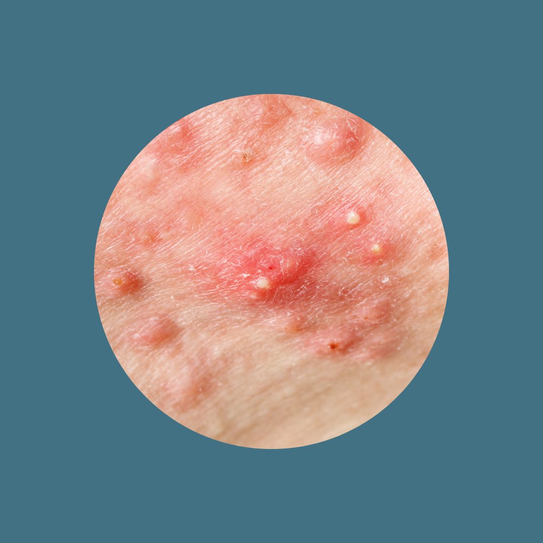 Acne products – Cascade Eye & Skin Centers