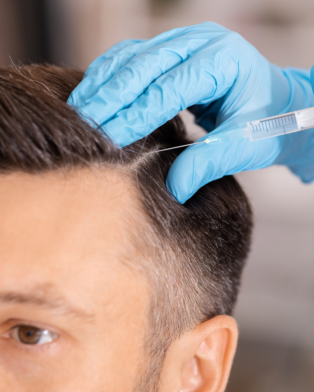 PRP Hair Restoration & Mesotherapy – Cascade Eye & Skin Centers