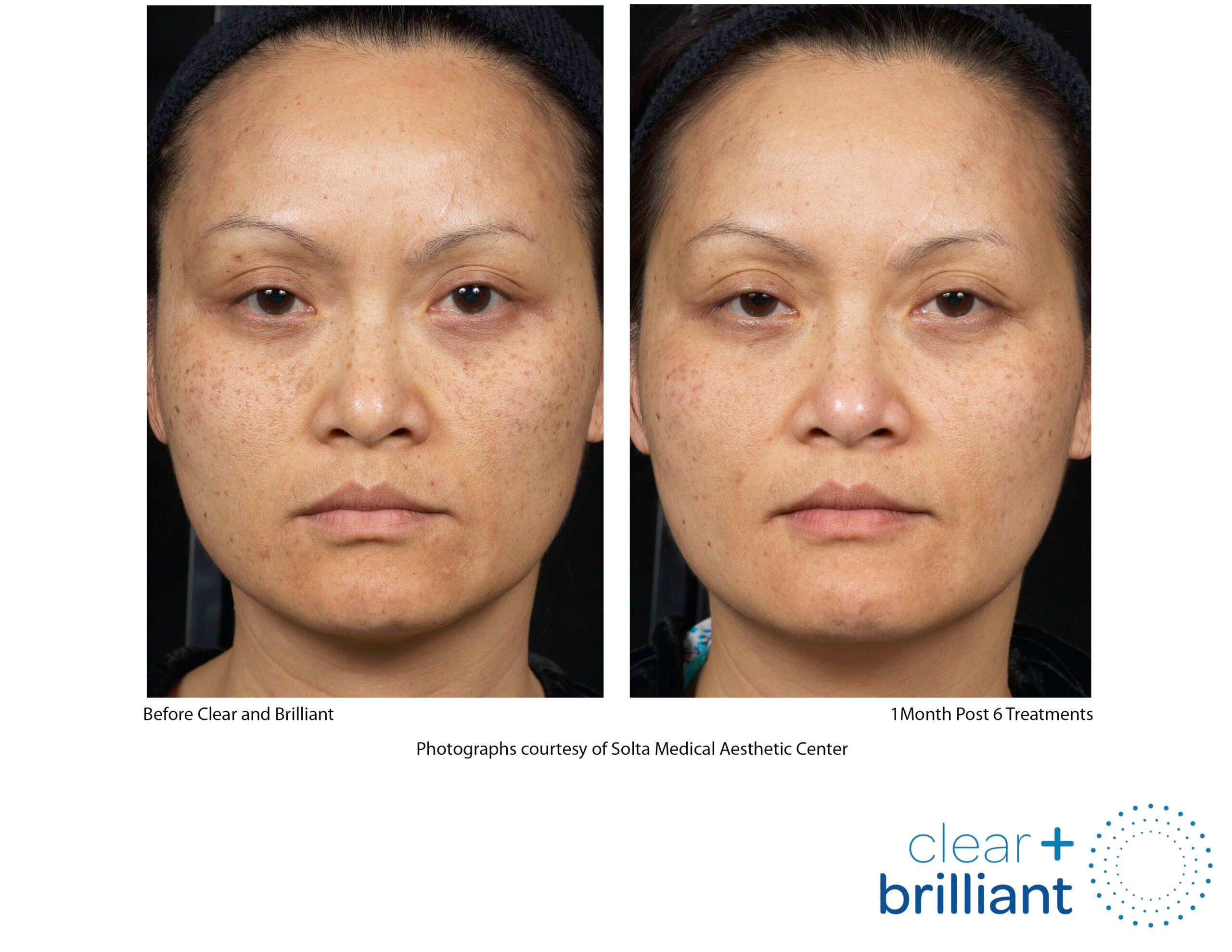 Clear & Brilliant Laser – Cascade Eye & Skin Centers